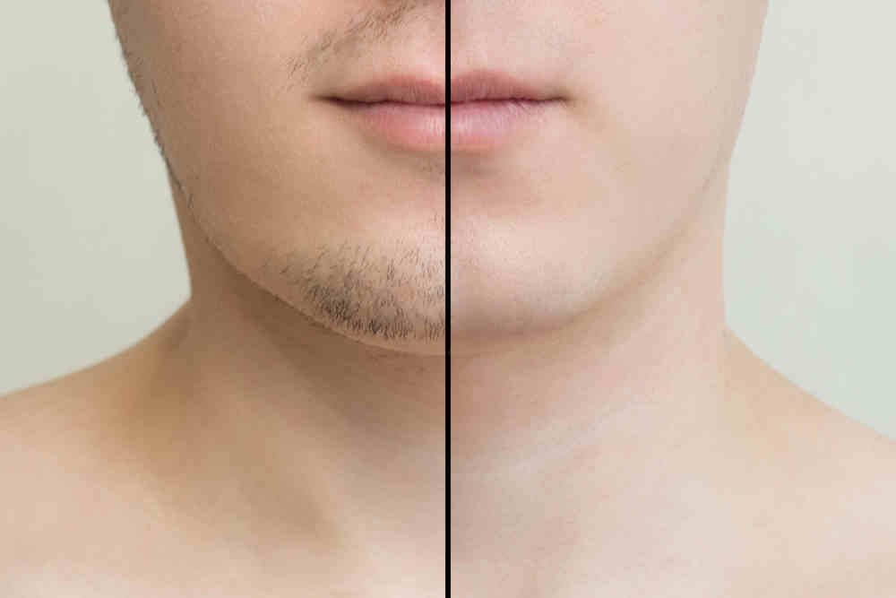 Barttransplantation In Istanbul Türkei Beste Kliniken And Ärzte 2024 2024